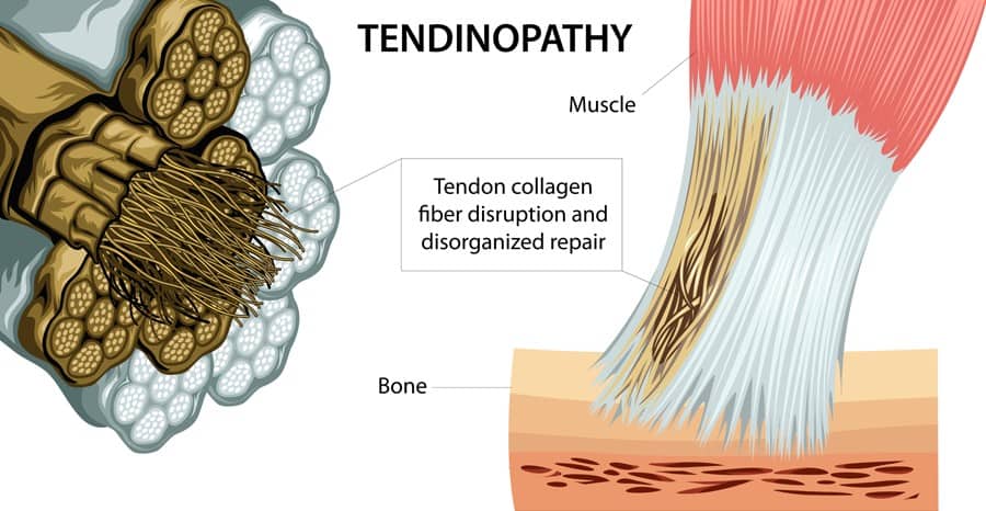 Tendinopathy | MGS Physiotherapy